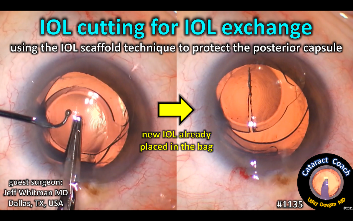 1135: IOL cutting for IOL exchange – Cataract Coach