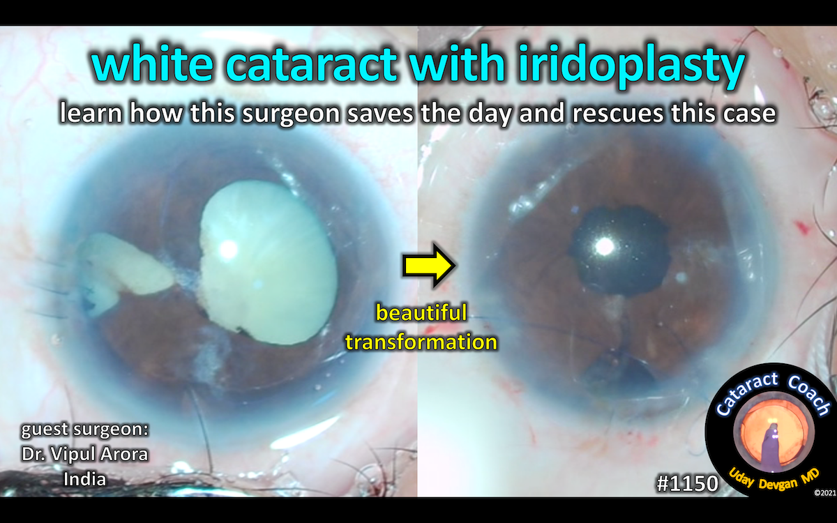 1150: white cataract with iridoplasty – Cataract Coach