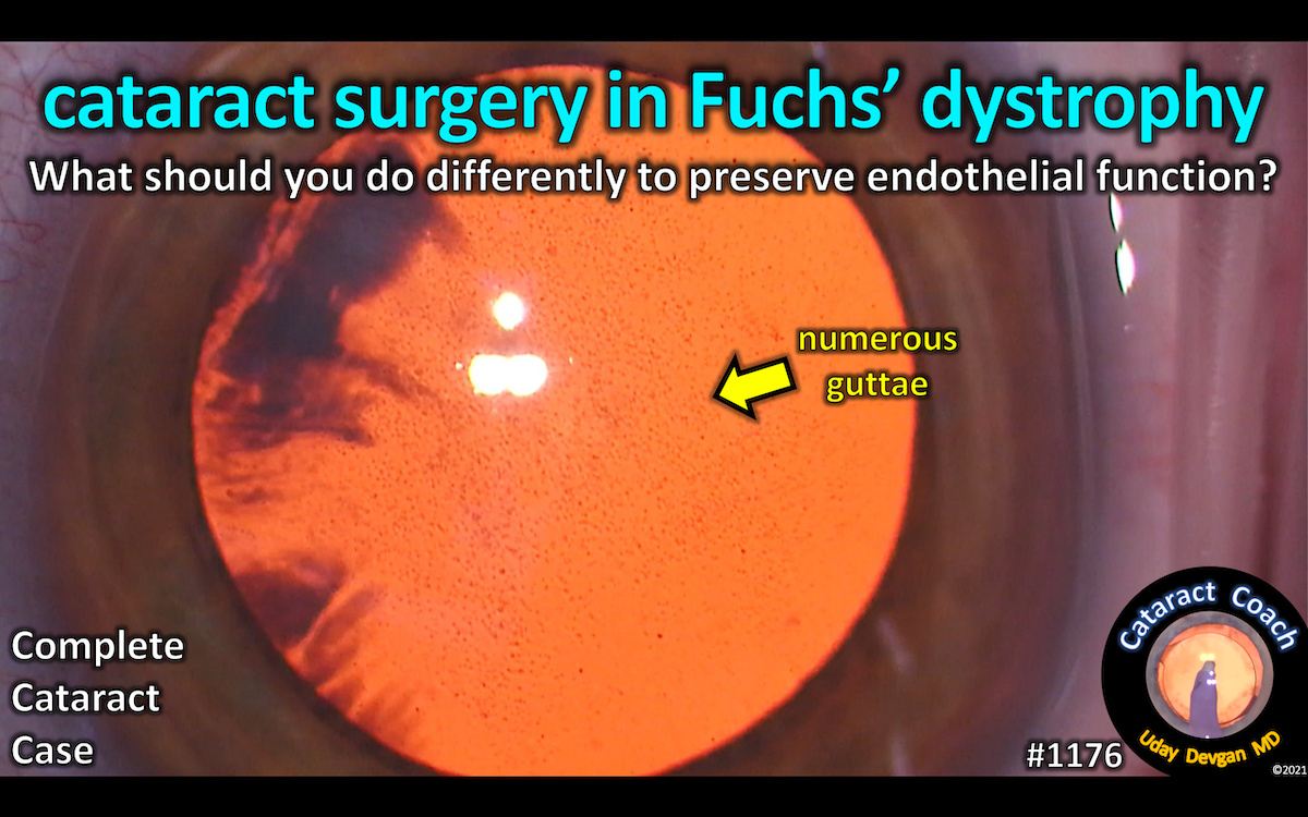 1176: cataract surgery in Fuchs’ dystrophy – Cataract Coach