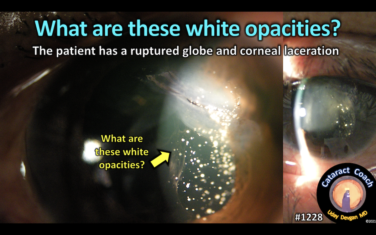 1228: Quiz: what are these white opacities? – Cataract Coach