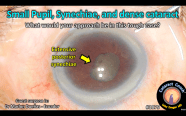 Small Pupil Cataract Surgery Cataract Coach 