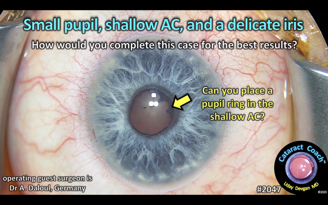 2047 shallow AC small pupil – Cataract Coach™