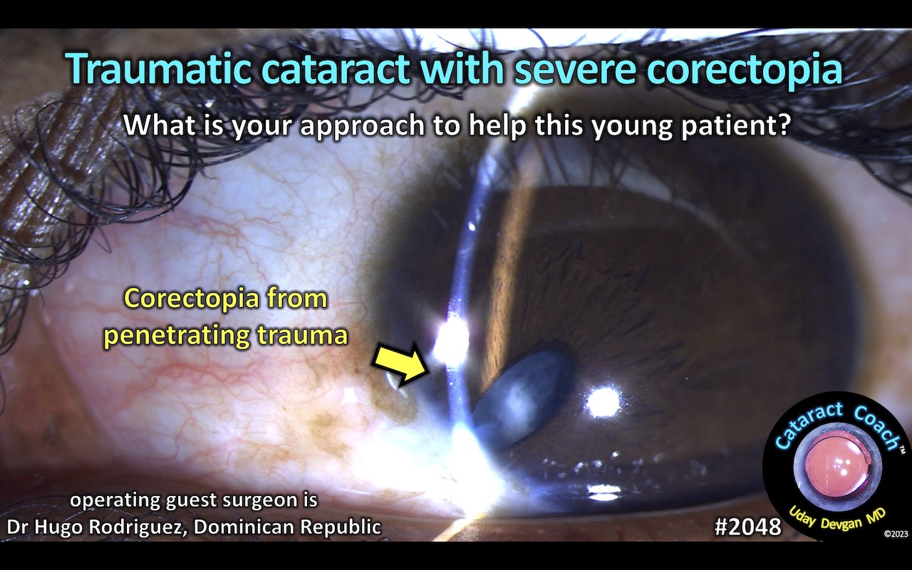 2048 traumatic corectopia – Cataract Coach™