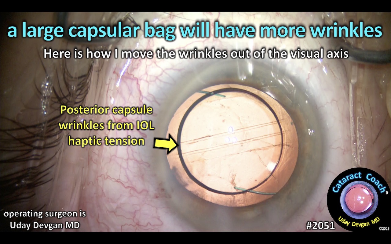 2051 post capsule wrinkles myope – Cataract Coach™