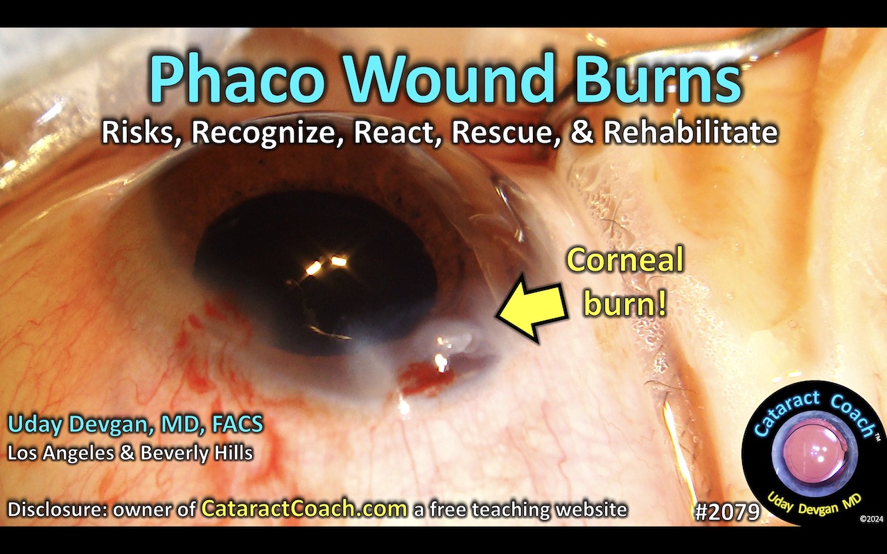 2079 phaco wound burns – Cataract Coach™