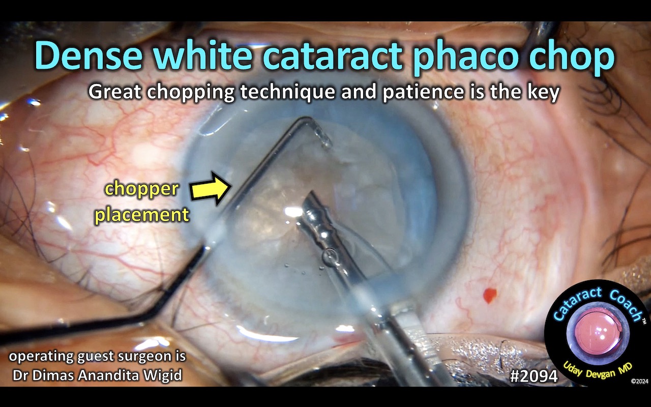 2094 phaco chop dense white – Cataract Coach™