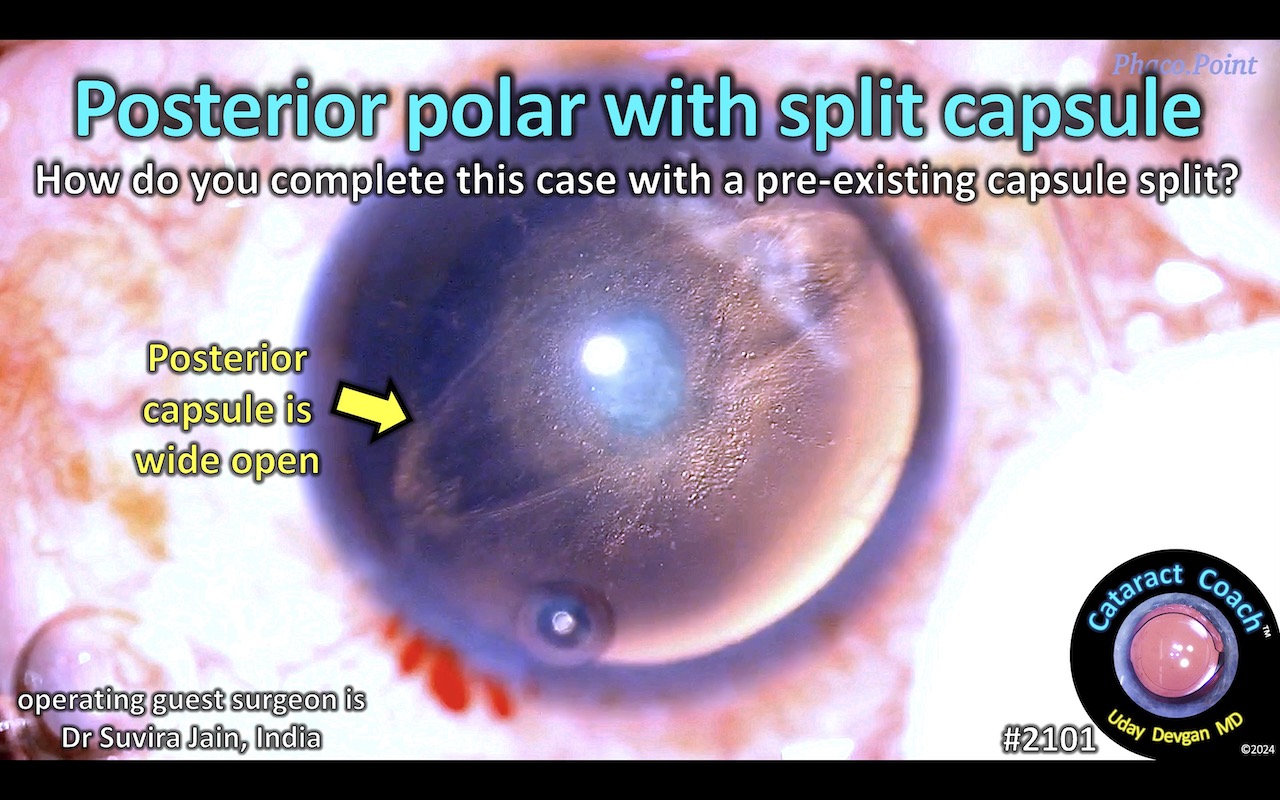 2101 posterior polar split capsule – Cataract Coach™
