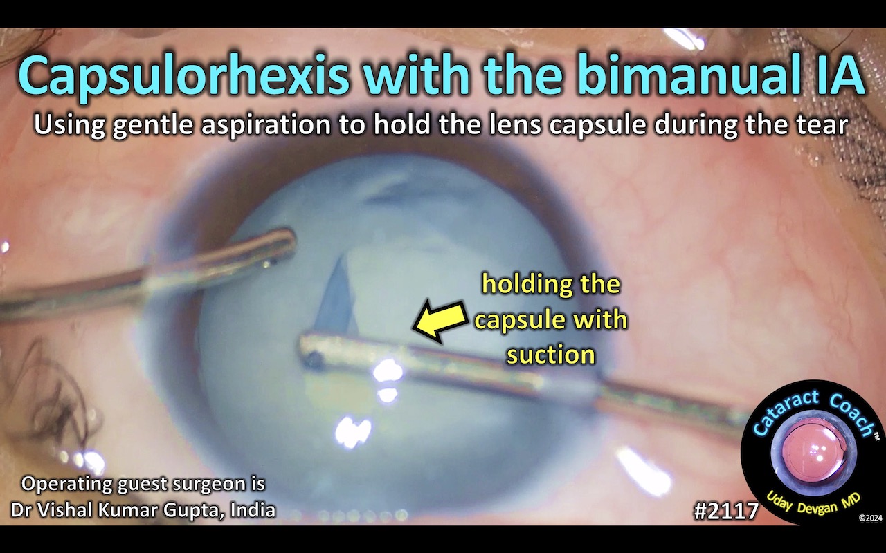 2117 capsulorhexis with IA – Cataract Coach™