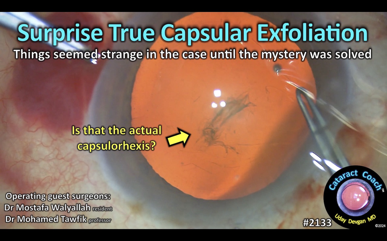 2133 true exfoliation capsule – Cataract Coach™