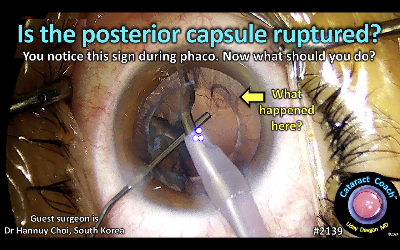 2139 is the posterior capsule ruptured – Cataract Coach™