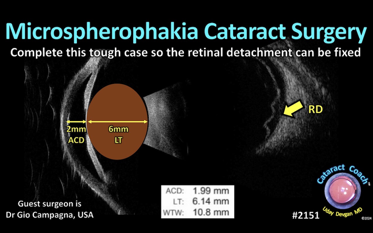 2151 microspherophakia – Cataract Coach™