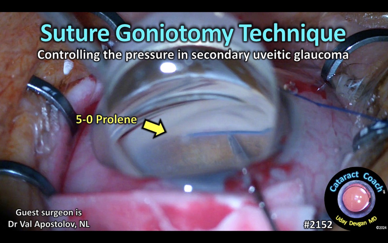 2152 suture goniotomy – Cataract Coach™
