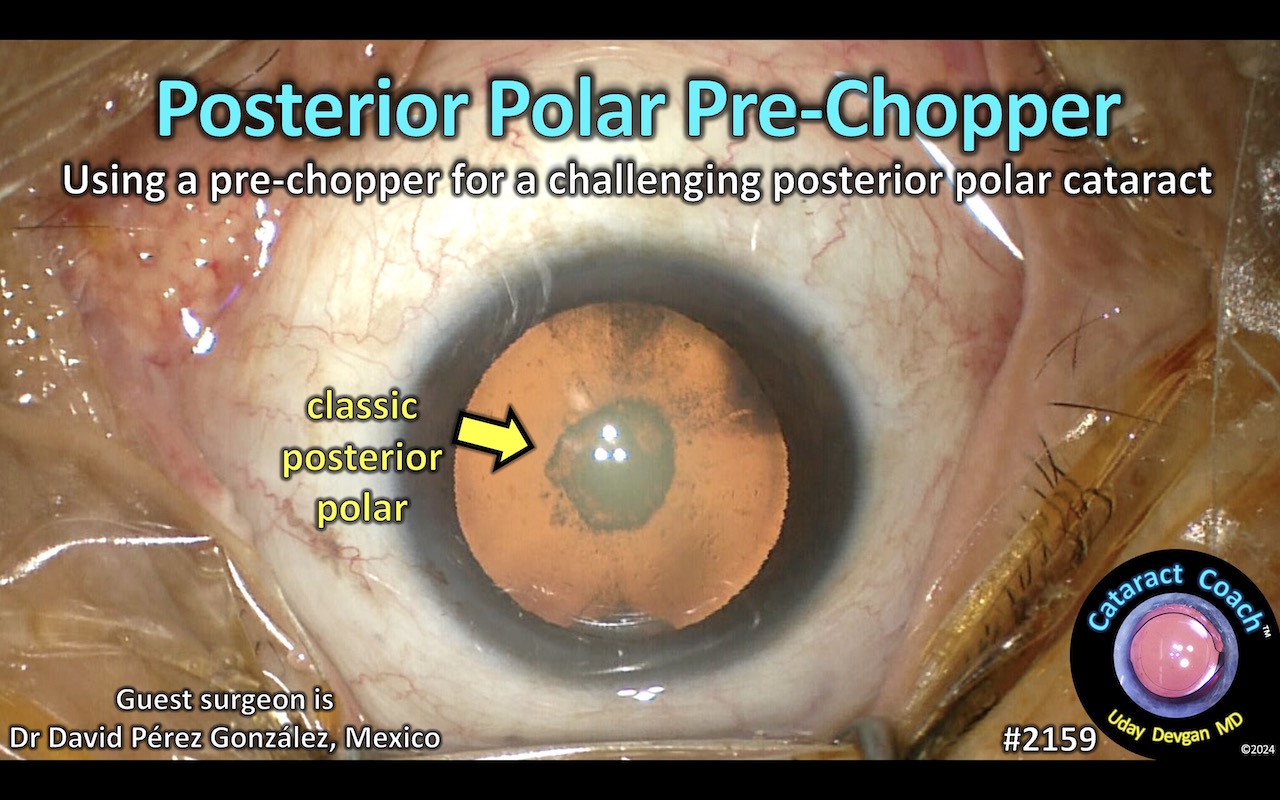 2159 posterior polar prechopper – Cataract Coach™
