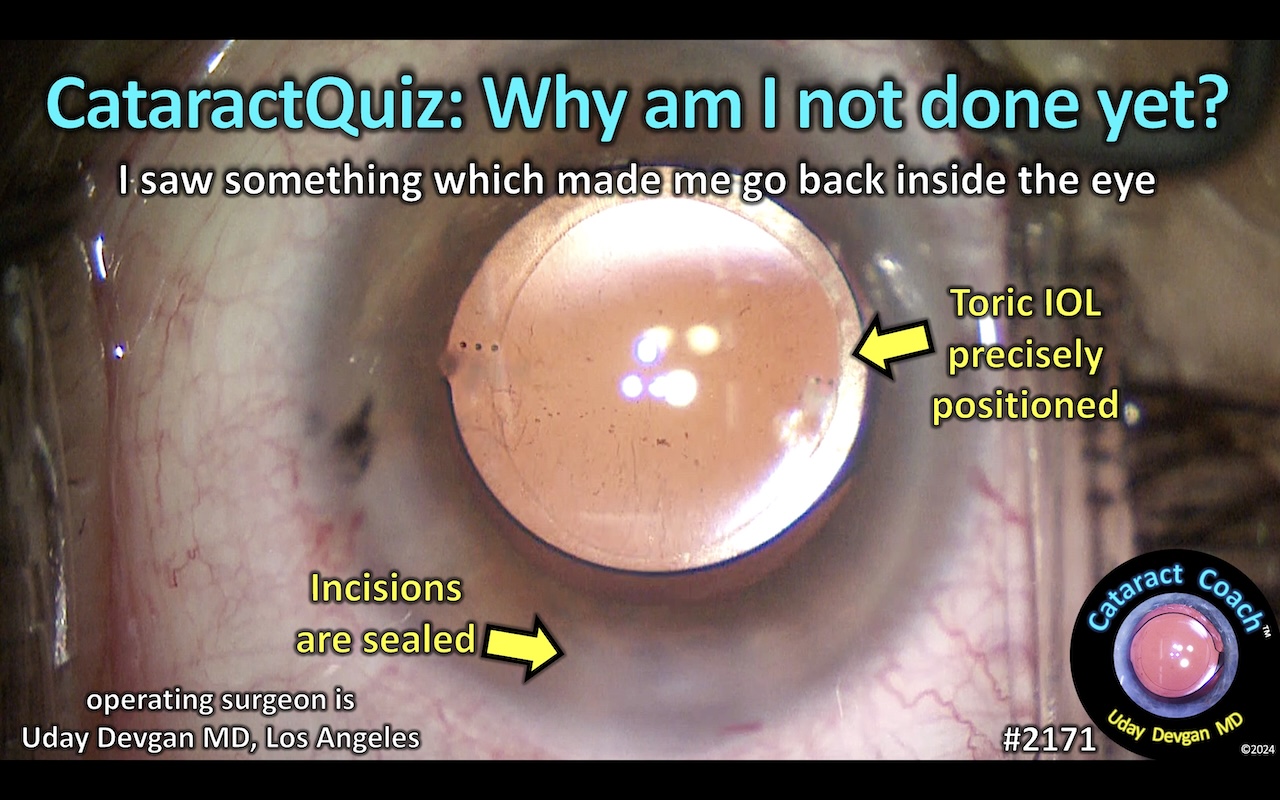 Screenshot – Cataract Coach™