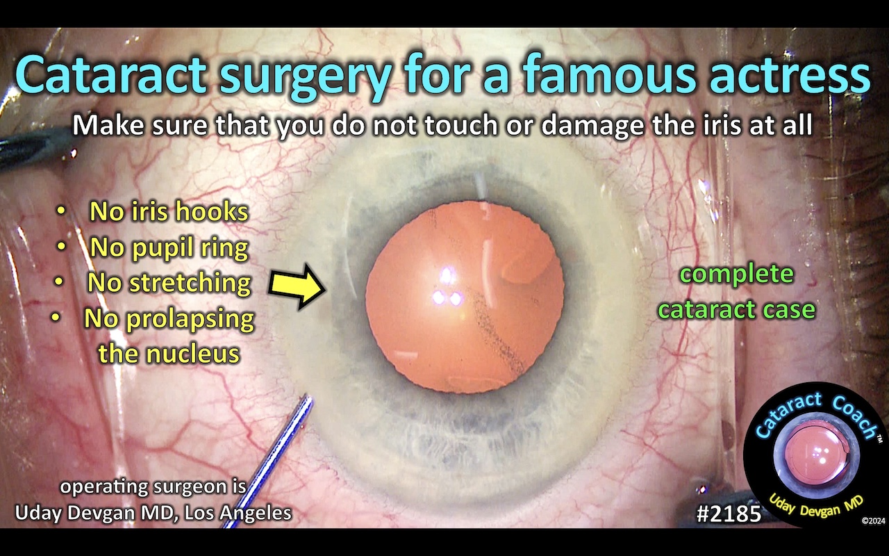 Screenshot – Cataract Coach™