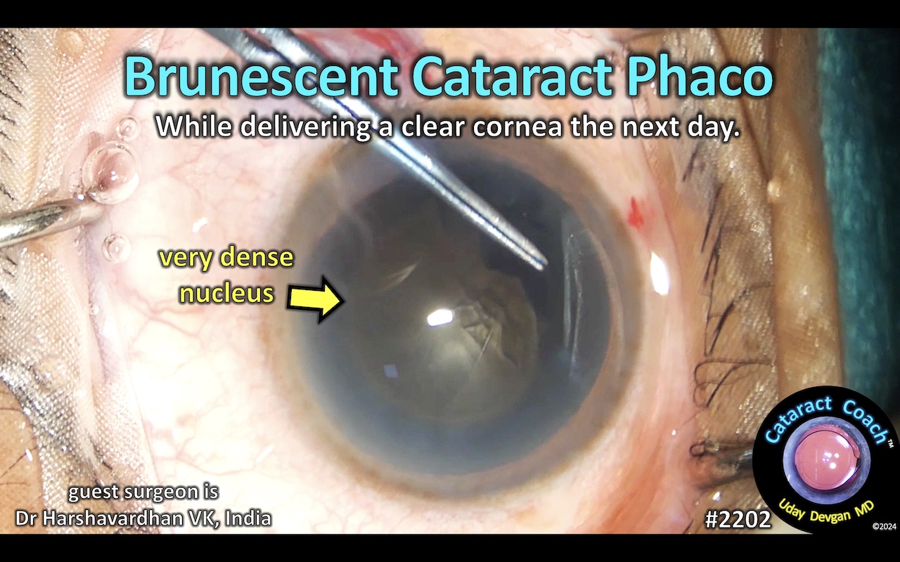 Screenshot – Cataract Coach™