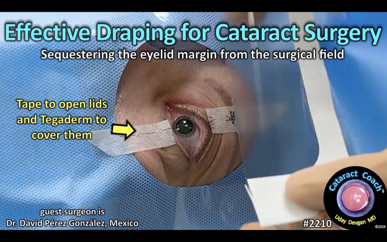Screenshot – Cataract Coach™