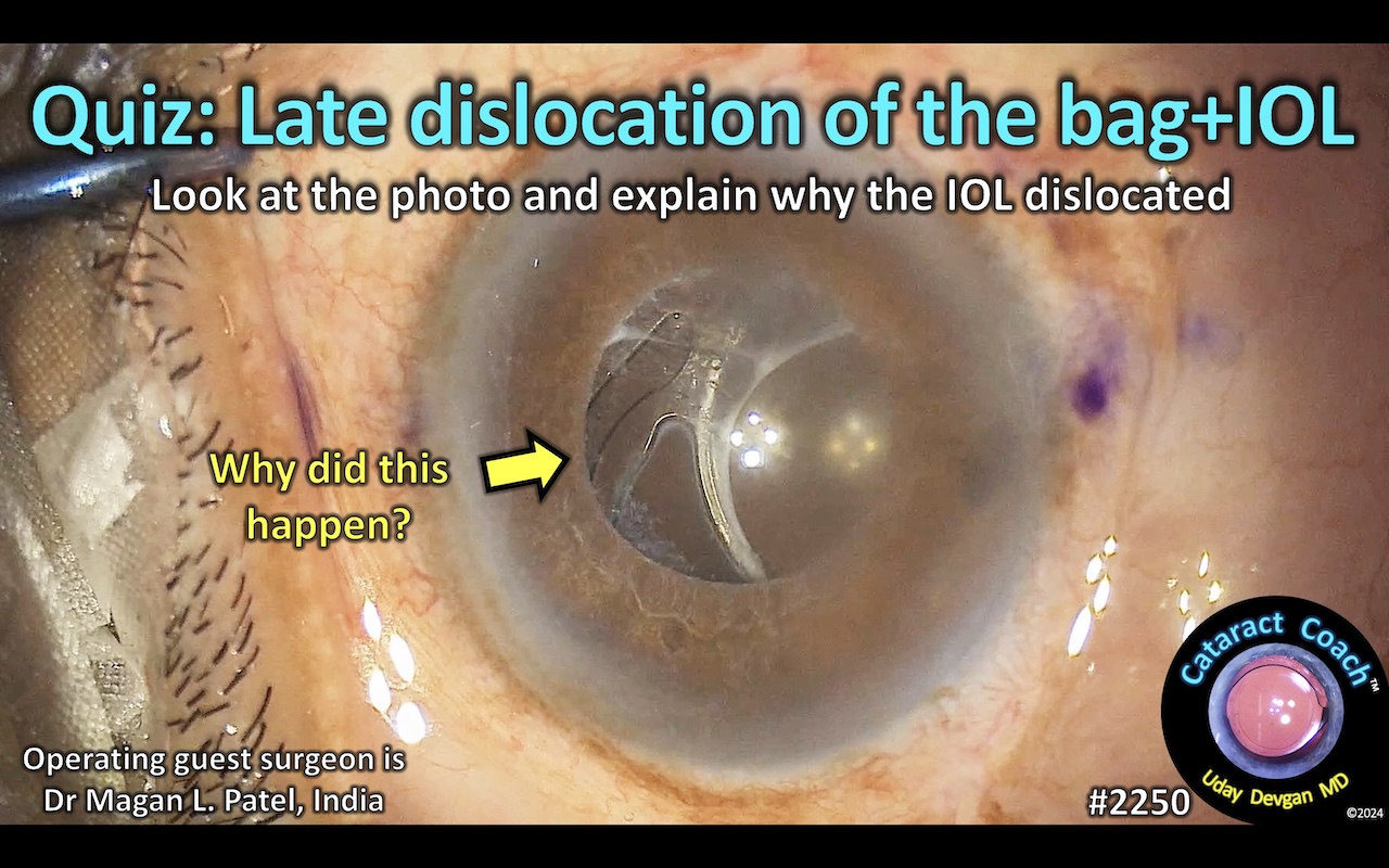 Screenshot – Cataract Coach™