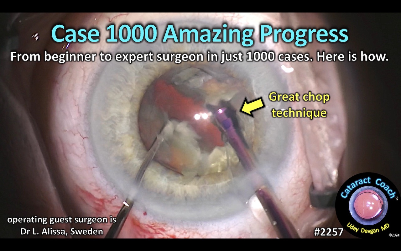 Screenshot – Cataract Coach™