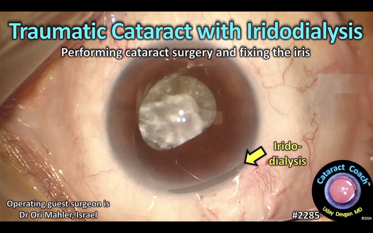 Screenshot – Cataract Coach™