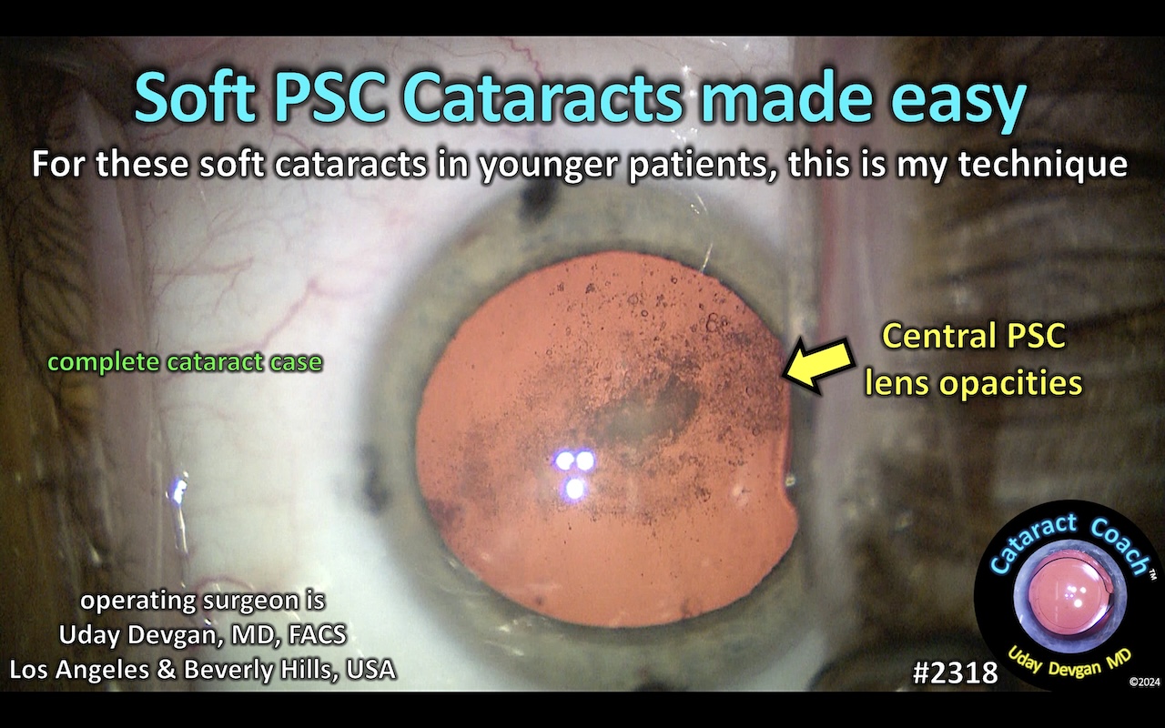Screenshot – Cataract Coach™