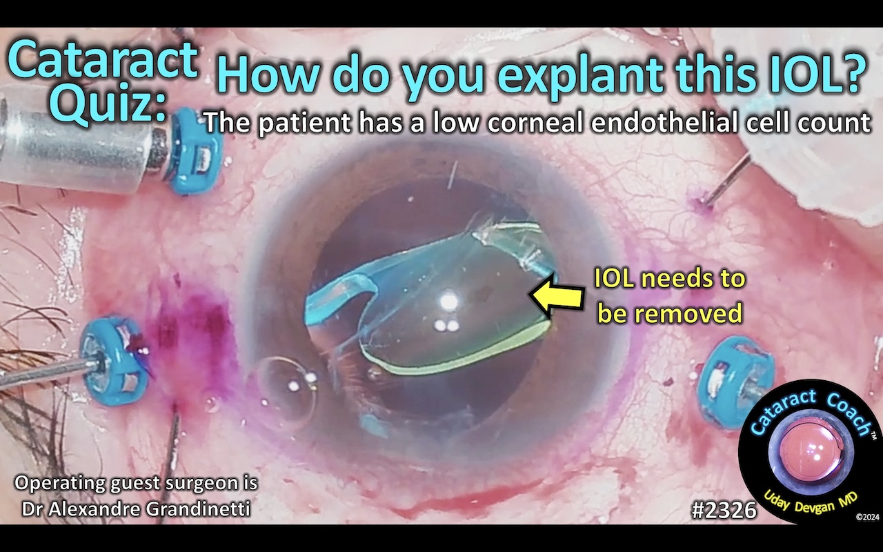 Screenshot – Cataract Coach™