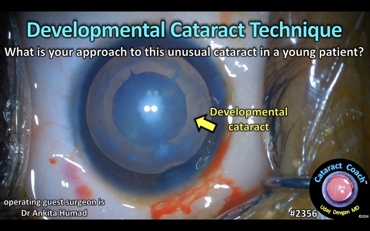 Screenshot – Cataract Coach™