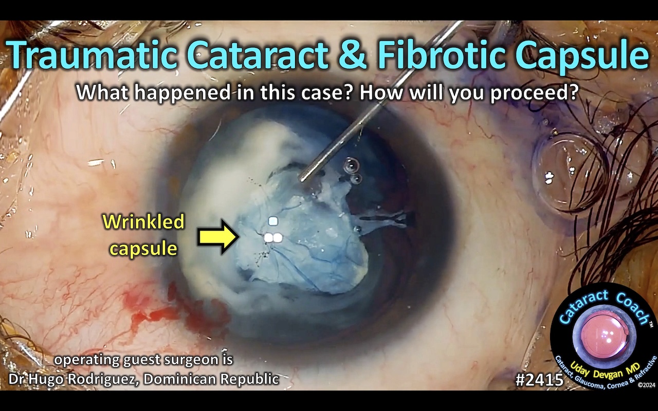 Screenshot – Cataract Coach™