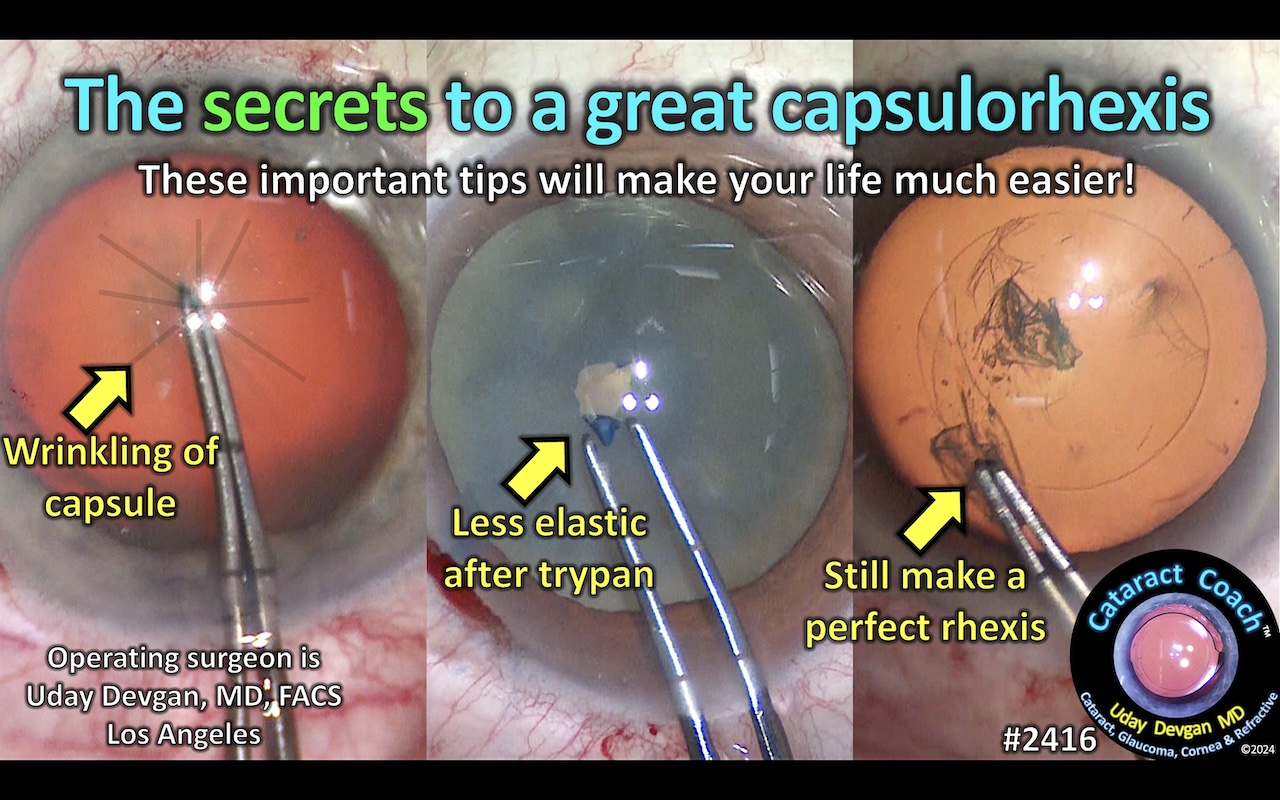 Screenshot – Cataract Coach™