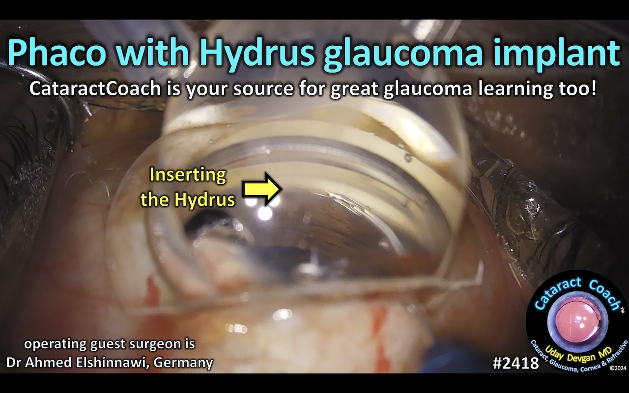 Screenshot – Cataract Coach™