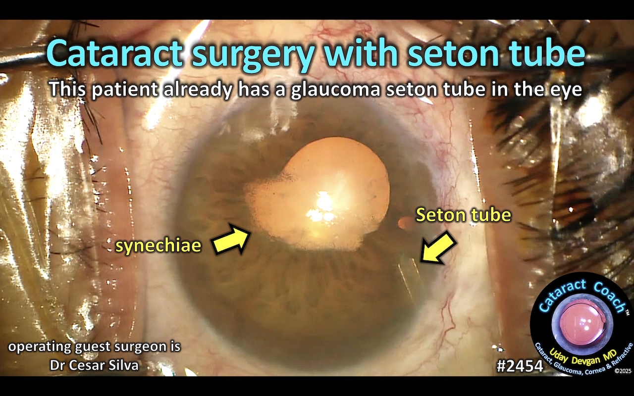 Screenshot – Cataract Coach™