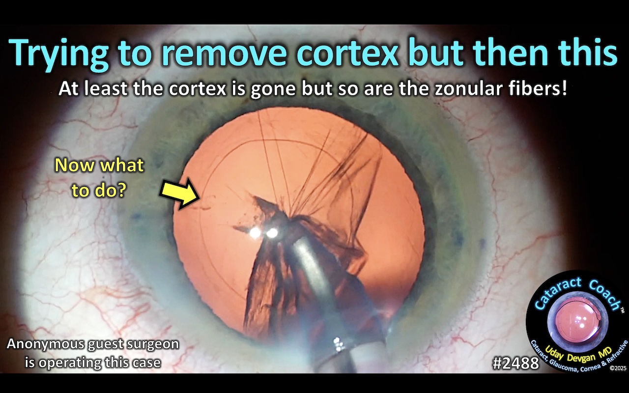 trying to remove cortex but then zonular breakage. now what?
