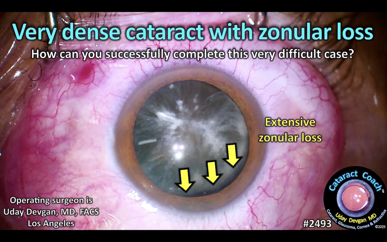dense brunescent cataract with zonular loss MSICS CTR