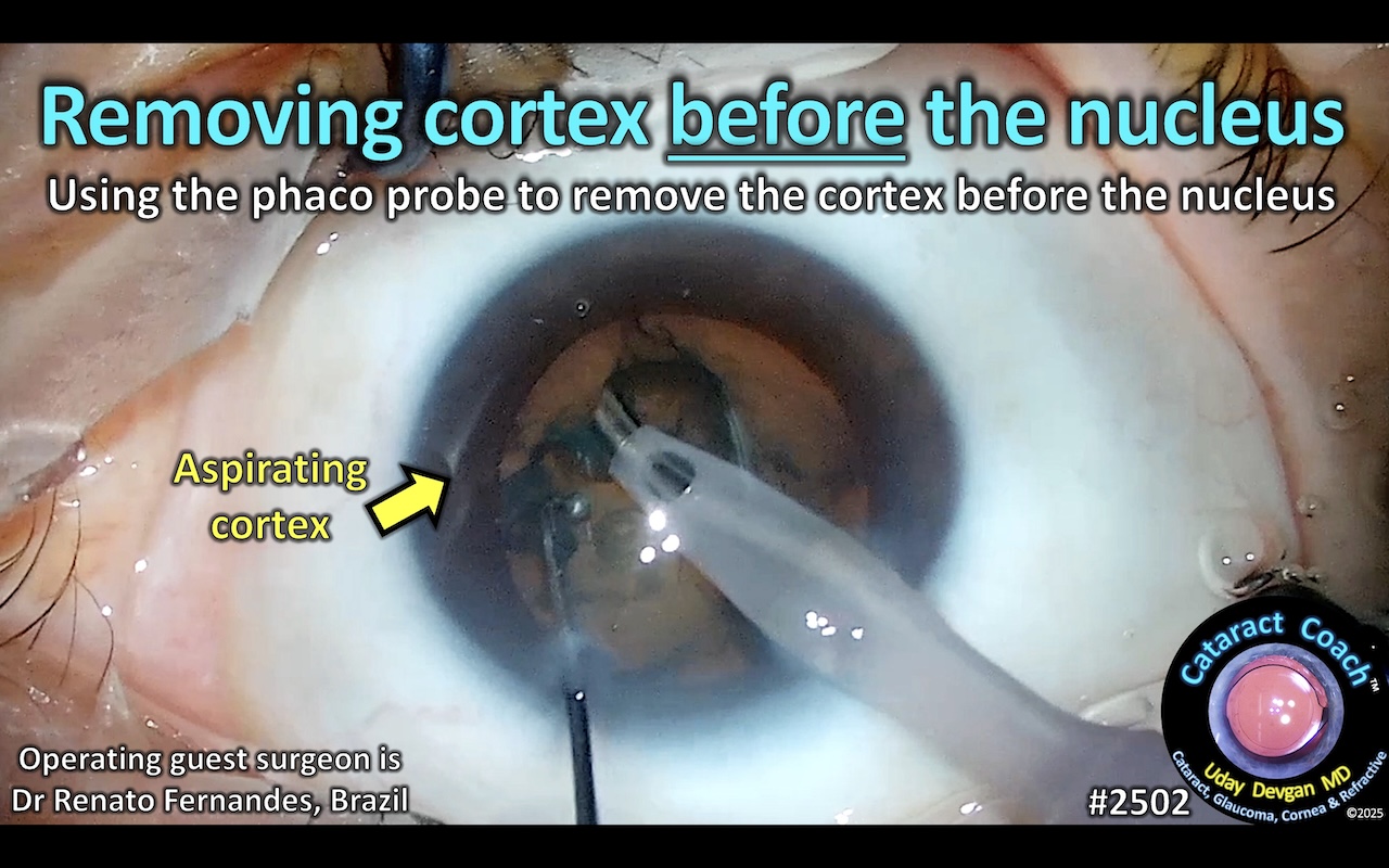 removing cortex BEFORE the nucleus in cataract surgery