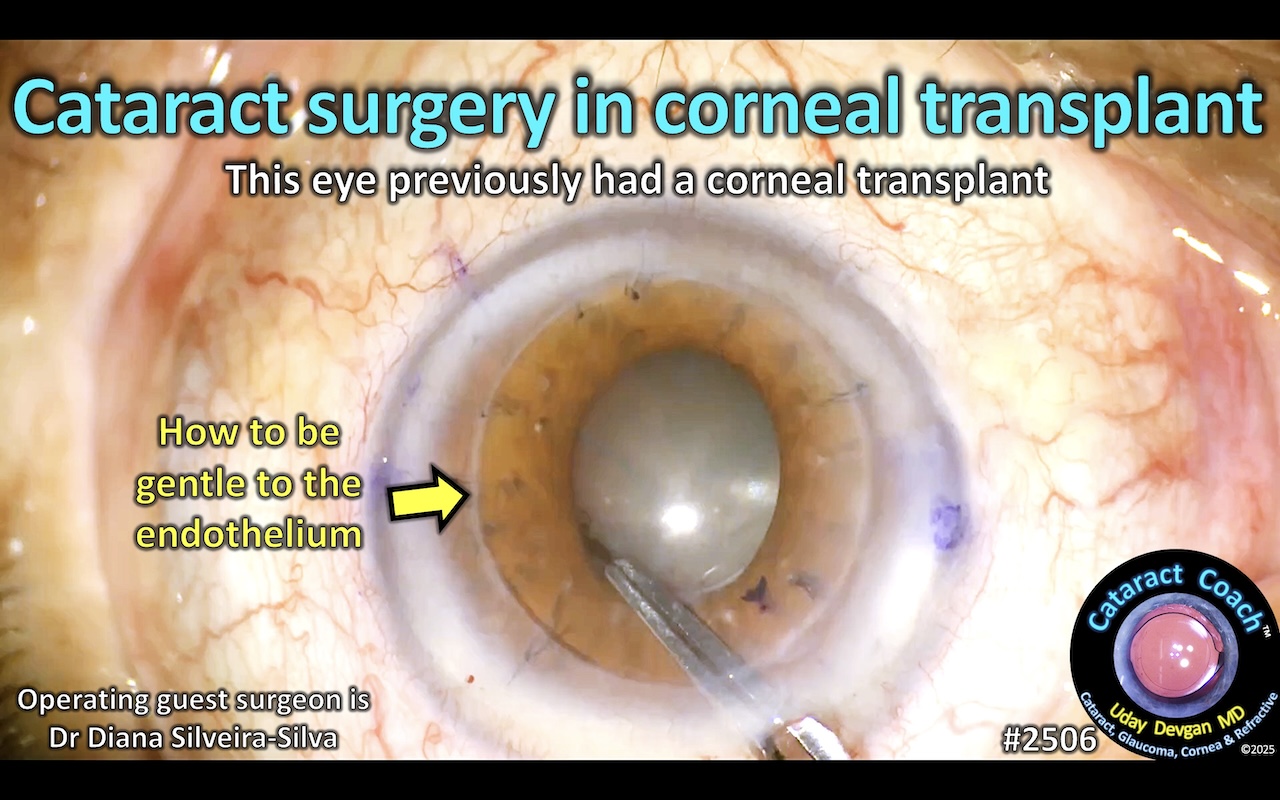 cataract surgery after corneal transplantation #cataract # ...