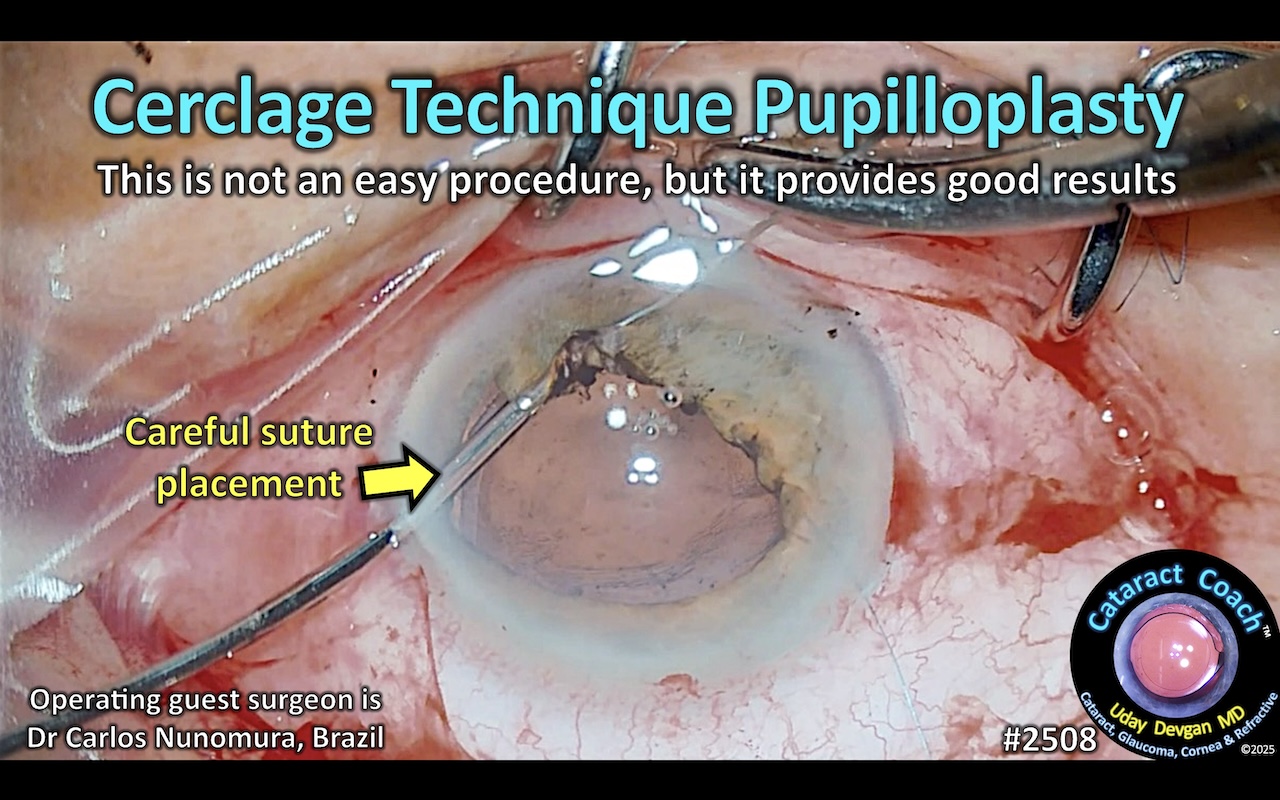 cerclage technique pupilloplasty during cataract surgery