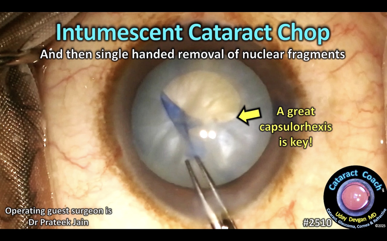 white cataract phaco chop technique