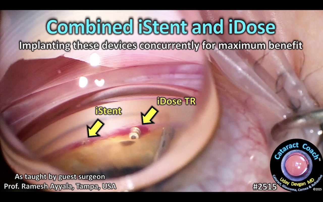 combined iStent and iDose TR for treatment of milder glaucoma