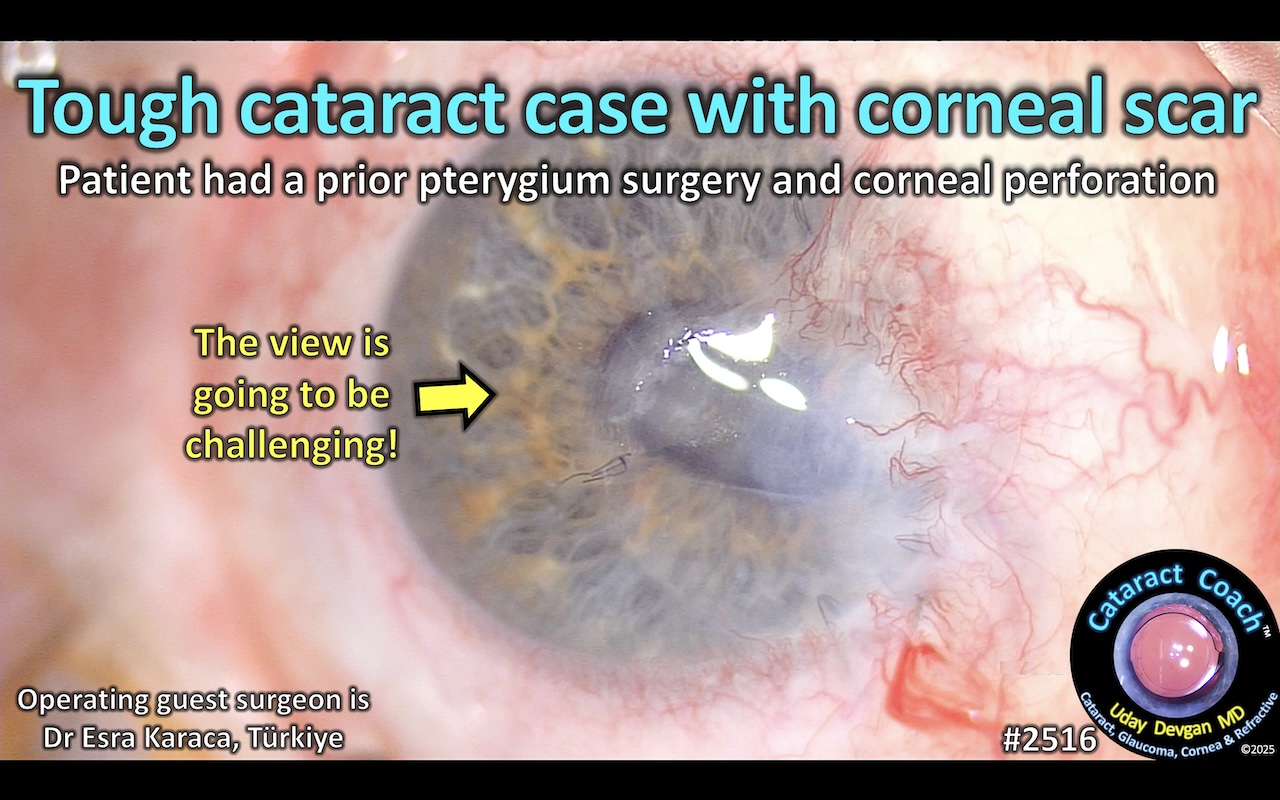 tough cataract surgery with corneal scar from prior trauma