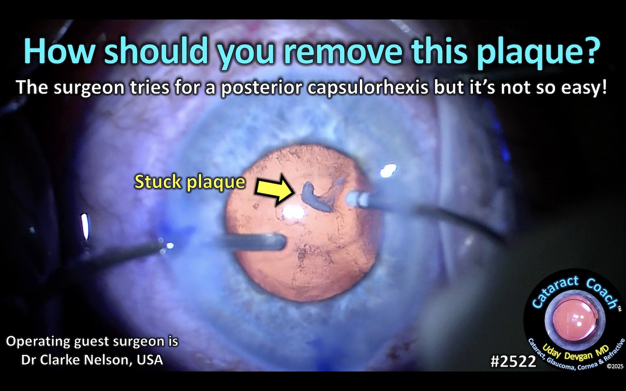 posterior sub capsular (PSC) cataracts – Cataract Coach™