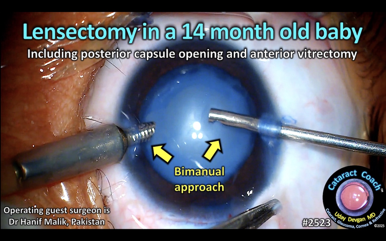 baby lensectomy with posterior capsulotomy anterior vitrectomy