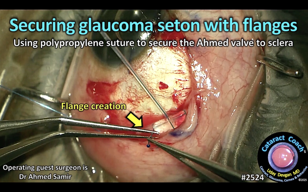 secure glaucoma seton with prolene flange sutures