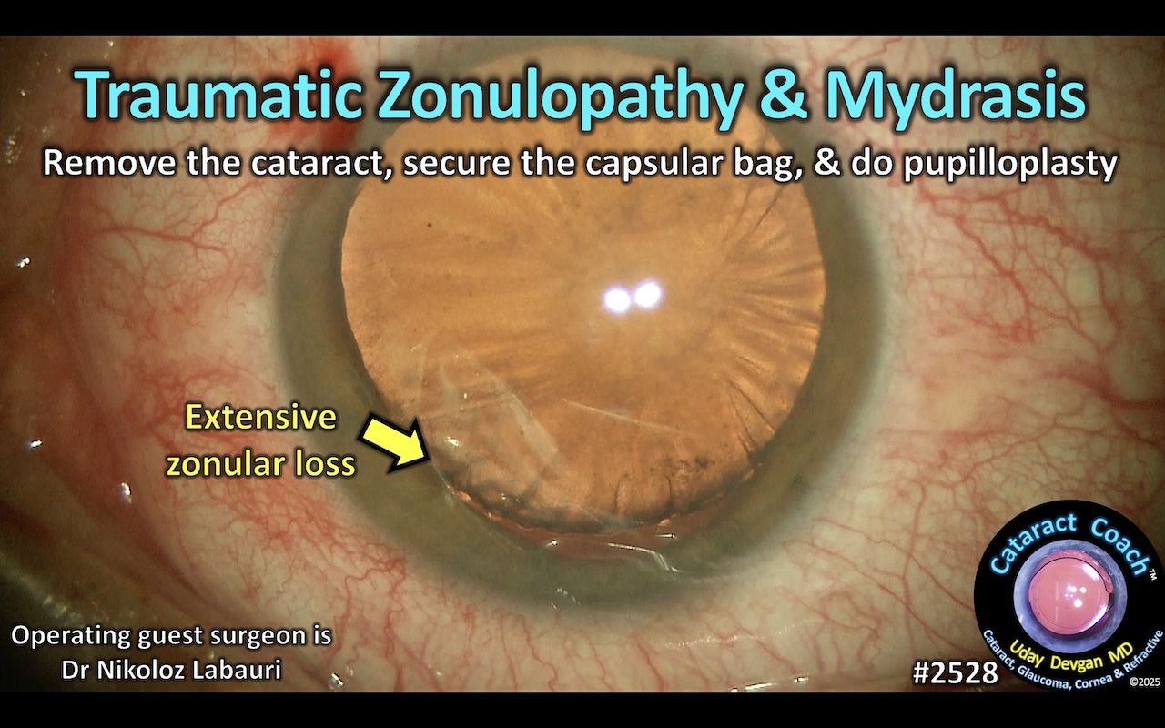 traumatic cataract with zonulopathy and mydriasis. pupilloplasty