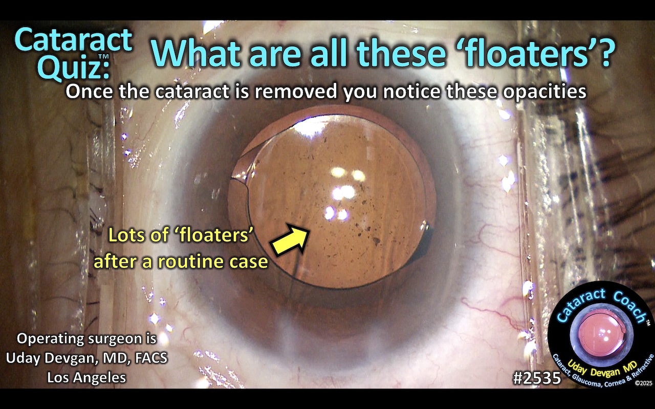 Cataract Quiz: What are these floaters after cataract surgery?
