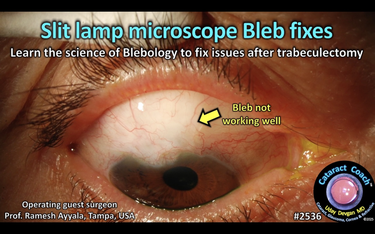 how to fix bleb issues at the slit lamp after glaucoma surgery trab