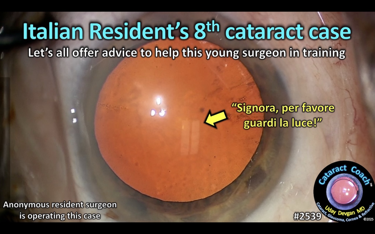 resident cataract surgery needs to keep the eye in primary position!