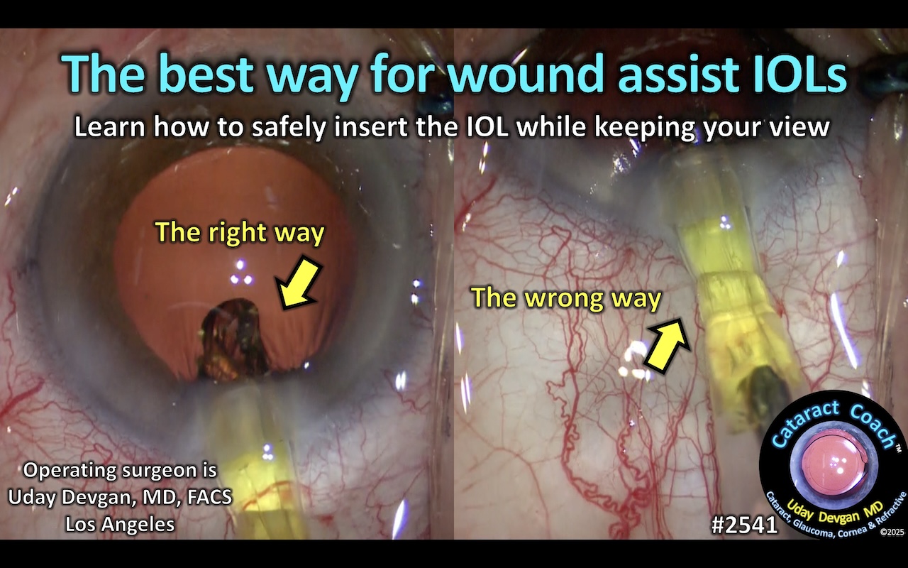 best way for wound assist IOL insertion in cataract surgery