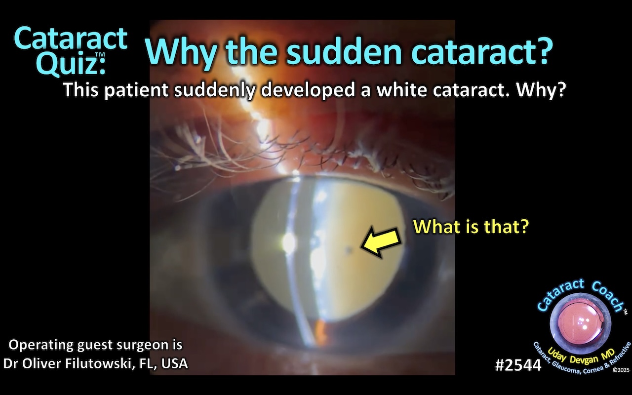cataract quiz: why did this patient suddenly develop a white cataract?