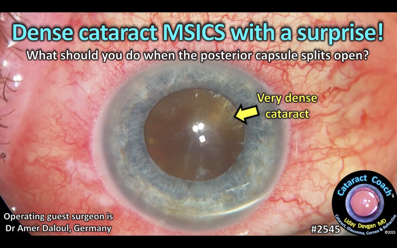 dense cataract MSICS with a surprise capsule break and sulcus IOL
