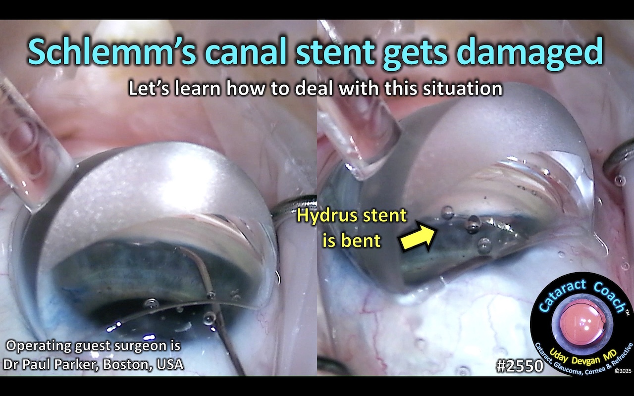 Schlemm's canal MIGS stent gets damaged. Kinked Hydrus so now what?